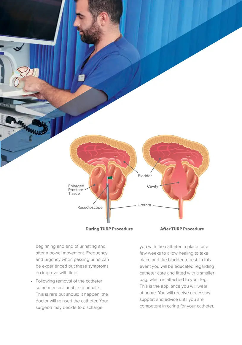 Trans-Urethral Resection of Prostate (TURP)